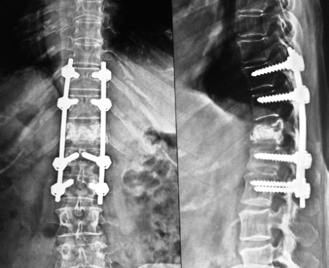 OSTEOPOROSIS CLINIC - Stavya Spine Hospital