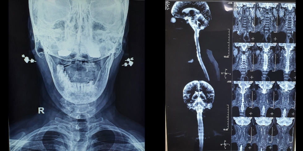 Atlantoaxial Osteoarthritis - Stavya Spine Hospital